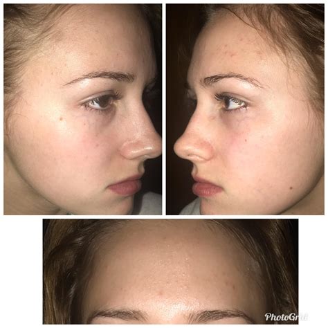Acne How Can I Get Rid Of These Tiny Bumps On My Forehead R