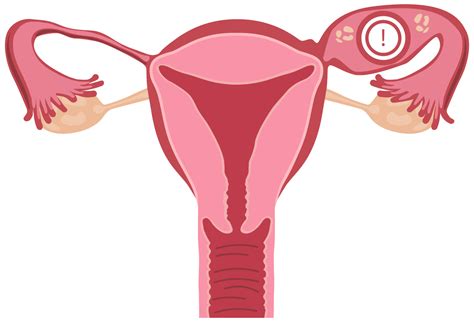 Mirena Removal What To Expect During And After Iud Removal