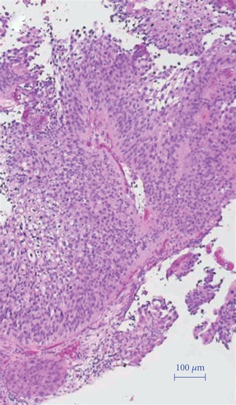 Pathological Findings Pathological Findings Revealed Invasive