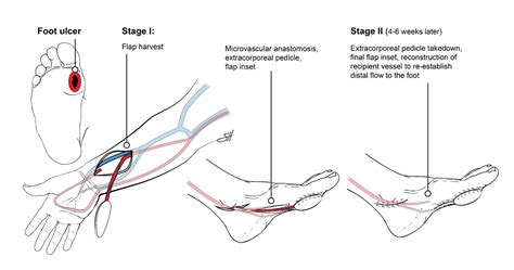 Extracorporeal Pedicles For Free Flap Reconstruction In Diabetic Lower