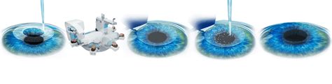 Presbyond Tindakan Alternatif Lasik Bagi Mata Tua