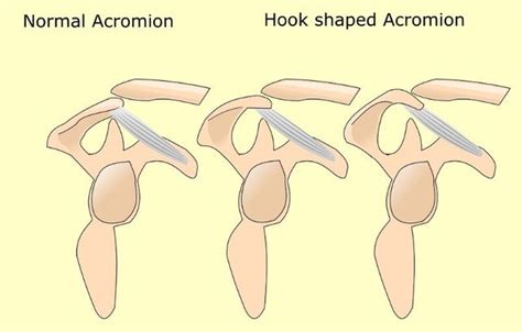 Types Of Acromion Shapes