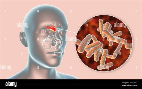 Bacterial Sinusitis Computer Illustration The Sinuses Are Membrane