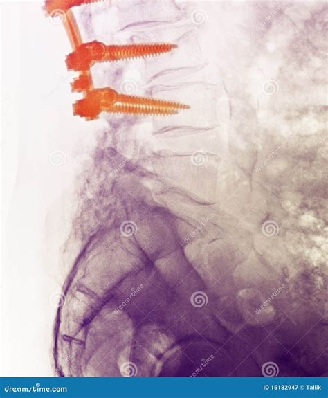 X Ray Showing Spinal Fusion Stock Image 15182947