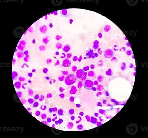 Photomicrograph Bone Marrow Study Megakaryocytic Hyperplasia 43292156