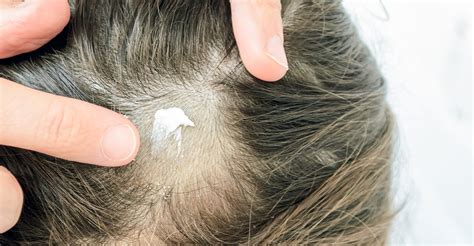 Common Scalp Infections And Hair Loss Hair Restoration Clinic