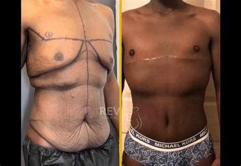 Skin Removal After Massive Weight Loss 010 Before And After Result Photos