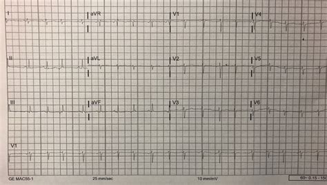 Electrical Alternans