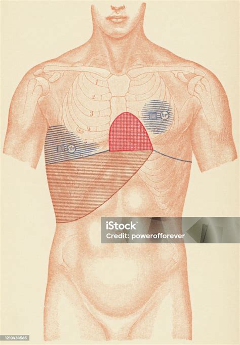 폐 침범 환자를위한 청진기와 타악기 포인트를 가진 인간의 몸통의 의료 그림 전면보기 19 세기 0명에 대한 스톡 벡터 아트 및