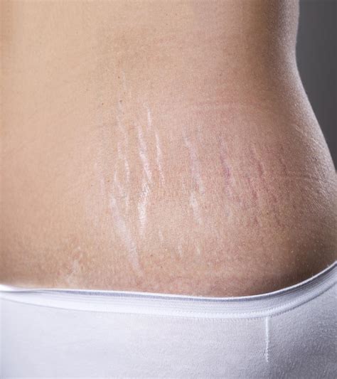 How To Remove Stretch Marks After Pregnancy 16 Home Remedies And Medical