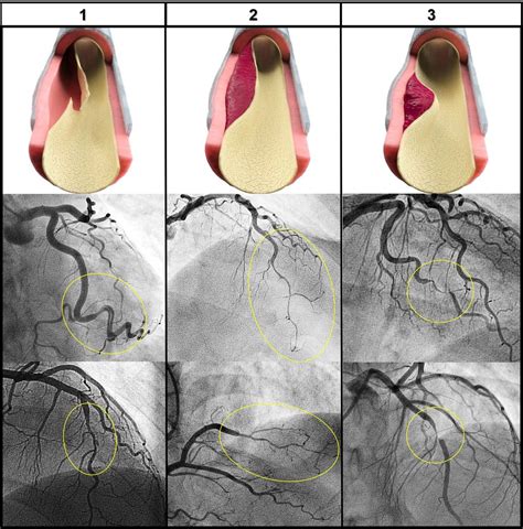 What Is A Dissection Of An Artery At Wilfred Furman Blog