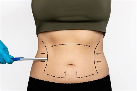 Entenda tudo sobre abdominoplastia lipoaspiração