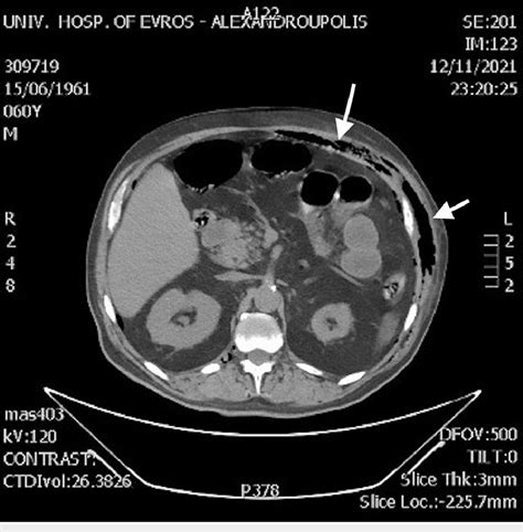 Ct Examination Of The Abdomen Revealed Free Air In The Abdominal Wall
