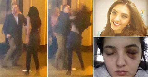 Stripper Fractured Cheekbone After Punch From Client That Pestered Her
