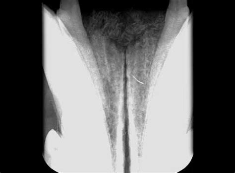 Radiograph Immediately Following Extractions And Socket Grafting Fig
