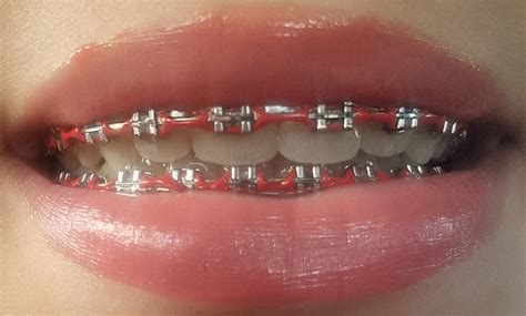 Red Braces 🥰 In 2025 Braces Colors Braces Tips Cute Braces Colors