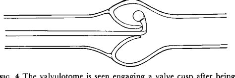 Figure 4 From Retrograde Valve Incision For Insitu Vein Arterial Bypass