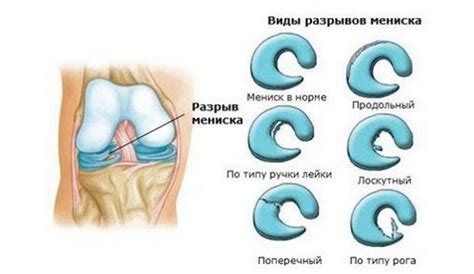 Мениск коленного сустава: что это, симптомы повреждений, лечение