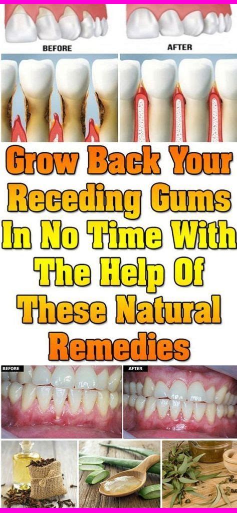 Grow Back Your Receding Gums In No Time With The Help Of These Natural