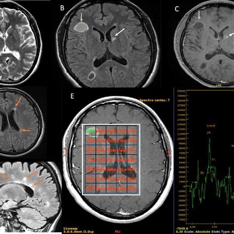 Brain Mri And Mr Spectroscopy Axial T2w A Axial Flair B And
