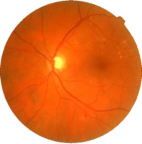 Figure 1 From Improving Microaneurysm Detection In Color Fundus Images By Using An Optimal