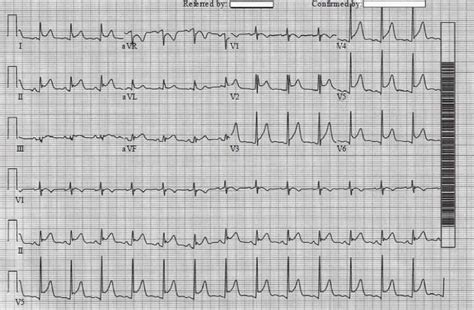 Acute Pericarditis Case File