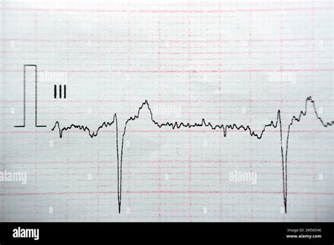 Ecg Electrocardiograph Paper That Shows Normal Sinus Rhythm Nsr With