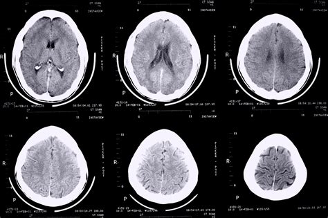 More Evidence That Exercise Can Help Fight Alzheimers Disease The