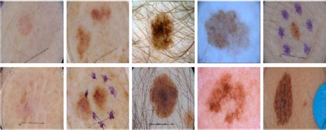 논문 리뷰 Tesl Net A Transformer Enhanced Cnn For Accurate Skin Lesion Segmentation