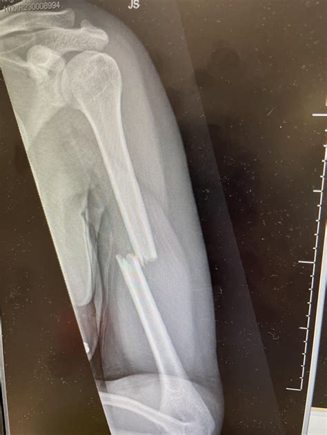 Broken Humerus R Xrayporn