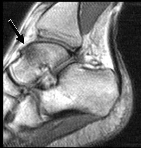 Stress Fracture Of The Talus Pacs