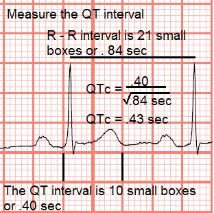 How To Calculate Qtc Manually Lasopaelegant