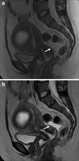 Mri In A 37 Year Old Patient With Necrotic Intramural Leiomyoma A