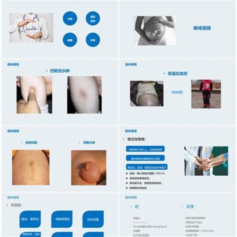 医疗原发性肾病综合征护理查房PPT模板 PPT模板 OVO图库