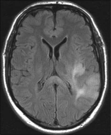 Forty Nine Year Old Man With A Diffuse Glioma Grade Axial FLAIR Download Scientific Diagram
