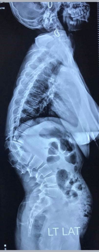 correction of congenital sharp angular kyphosis ns zag