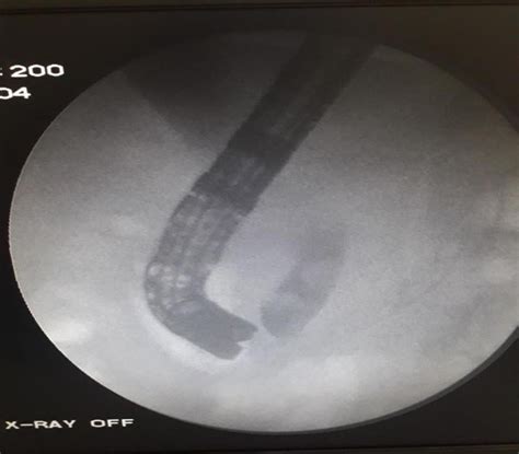 Showing Filling Defect In Cholangiogram No Filling Defect In Check