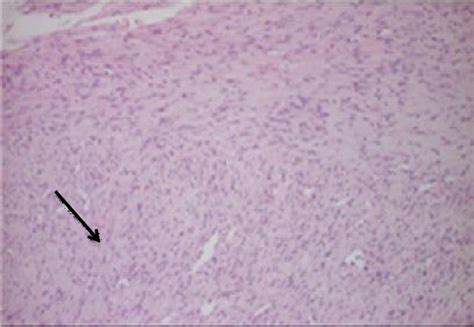 Partially Parallel Or Plexiform Arranged Spindle Cells With Slim And Download Scientific