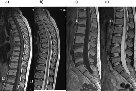Magnetic Resonance Imaging Findings For The Thoracic And Lumbar Spine