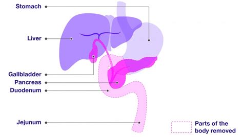 Total Pancreatectomy Pancreatic Cancer Awareness Pca