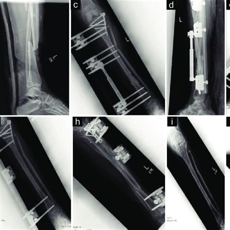 A Anteroposterior View Of An Open And Displaced Tibia Shaft Fracture