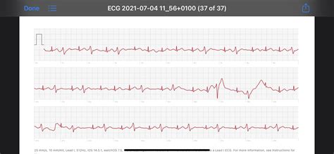 Just Had A Really Bad Run Of Ectopic Hearts Beats While Exercising Here Is 1 Ecg Ekg I Done It