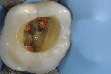 Cavità occlusale di un primo molare mascellare con cuspidi e creste