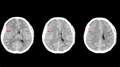 Qué Es El Hematoma Subdural Que Le Diagnosticaron A Diego Maradona Y Cómo Será La Operación