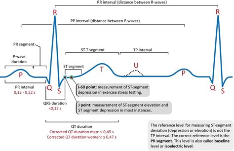 Isolated T Wave Inversions Active Ischemia Or Not Rcardiology