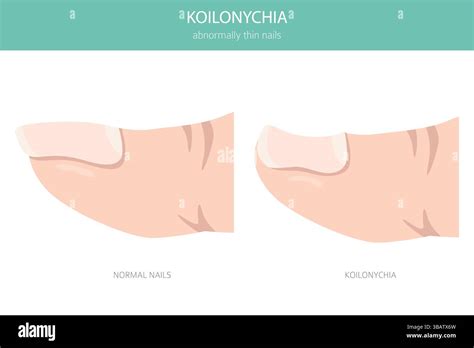 Koilonychia Or Spoon Nails Is A Nail Condition Where Nails Become