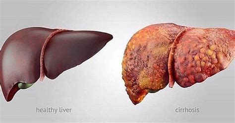 Healthy Liver Vs Cirrhotic Liver Medizzy