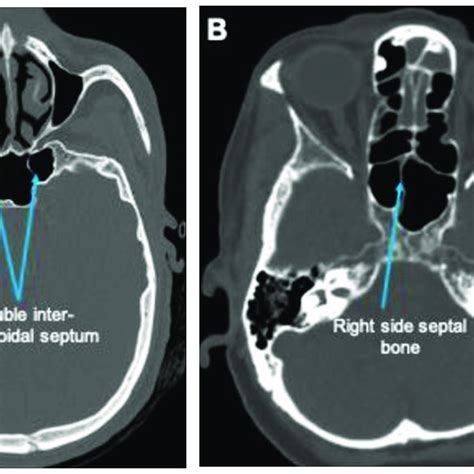 A Sagital View Pneumatization Of The Sphenoid Sinus Extending