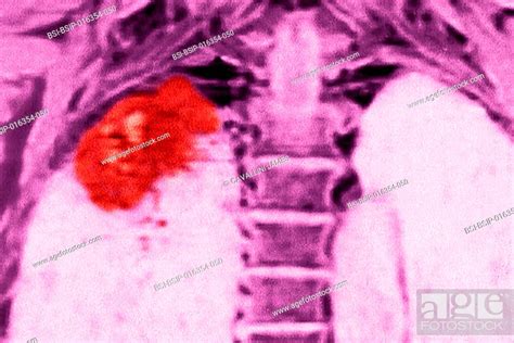 Lung Cancer Located In The Upper Right Lobe Frontal Chest X Ray Stock