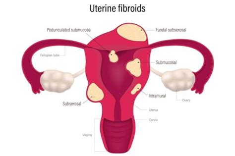 Pedunculated Fibroids How Do Fibroid Doctors Treat Them